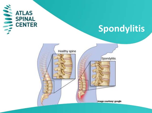 What is spondylitis | PPSX | Bone and Joint Conditions | Diseases and ...