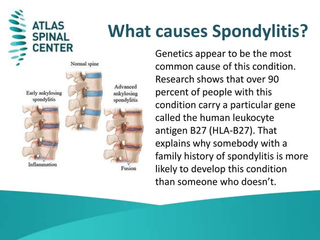 What is spondylitis | PPSX | Bone and Joint Conditions | Diseases and ...