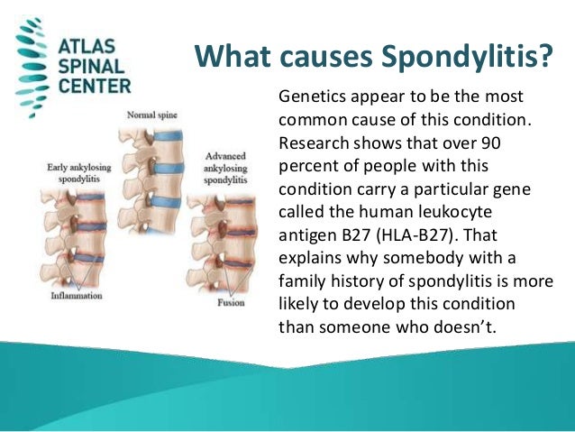 What is spondylitis