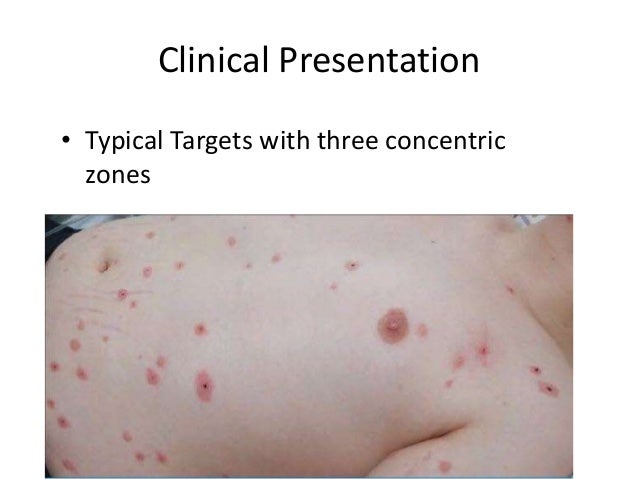 What is stevens johnson syndrome?