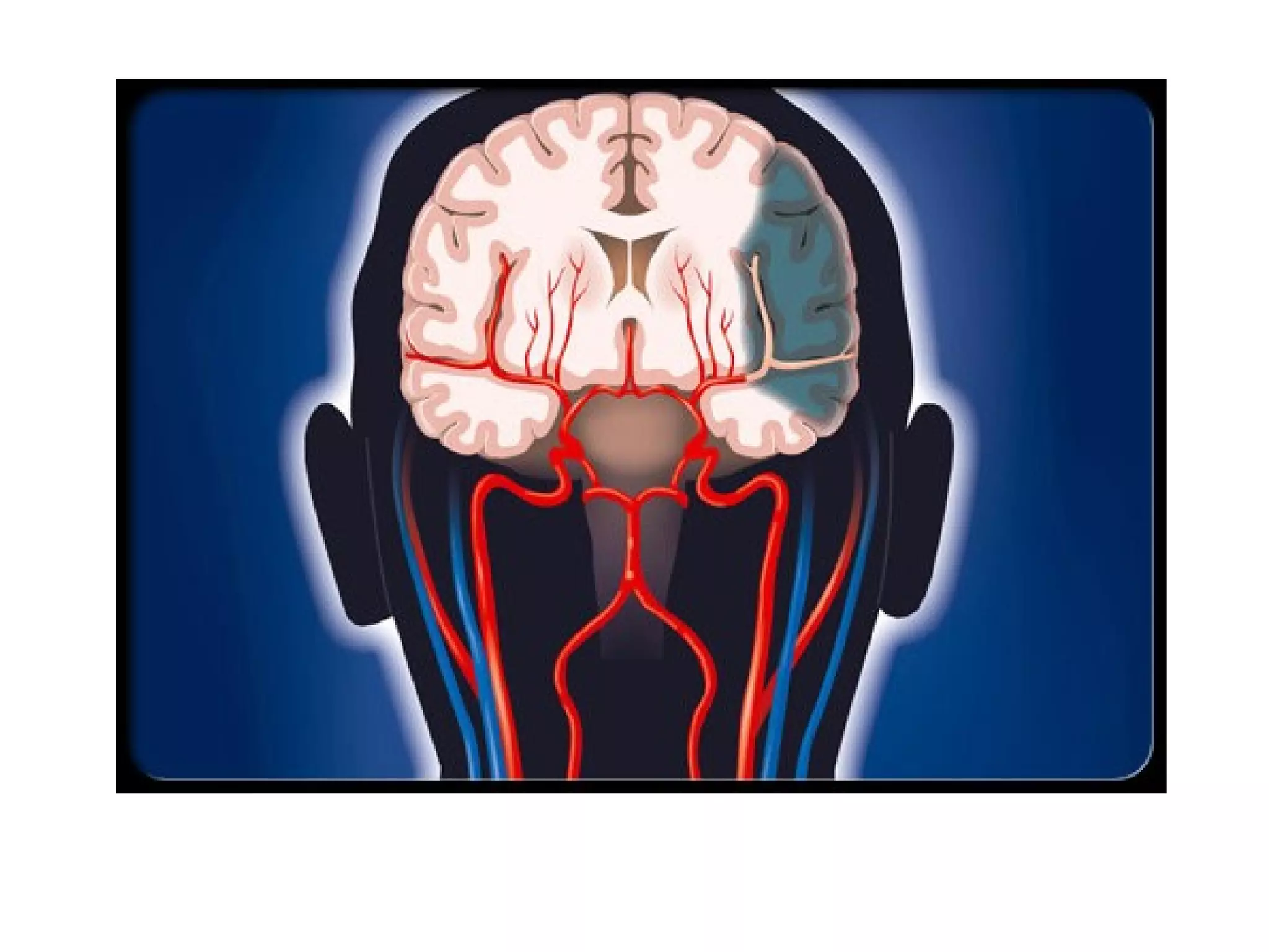 What is stroke | PPT