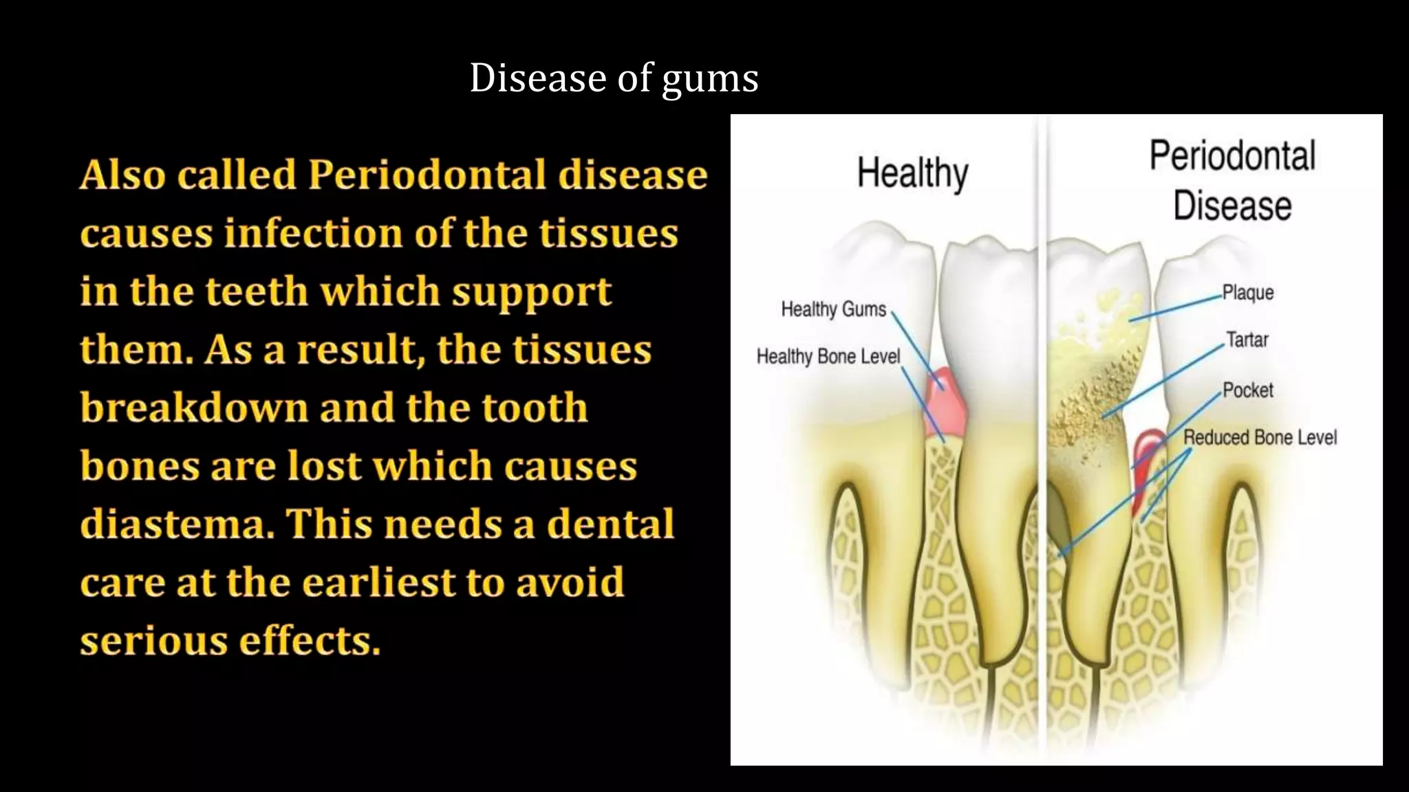 What is teeth spacing? – Its causes and cures | PPTX