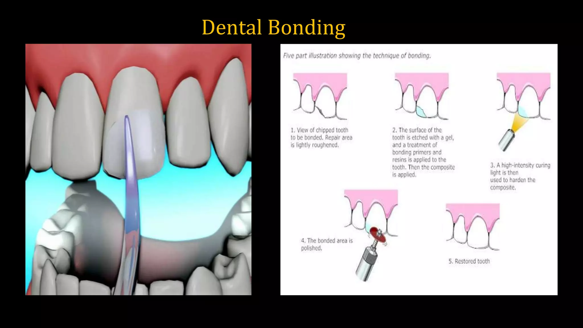 What is teeth spacing? – Its causes and cures | PPTX