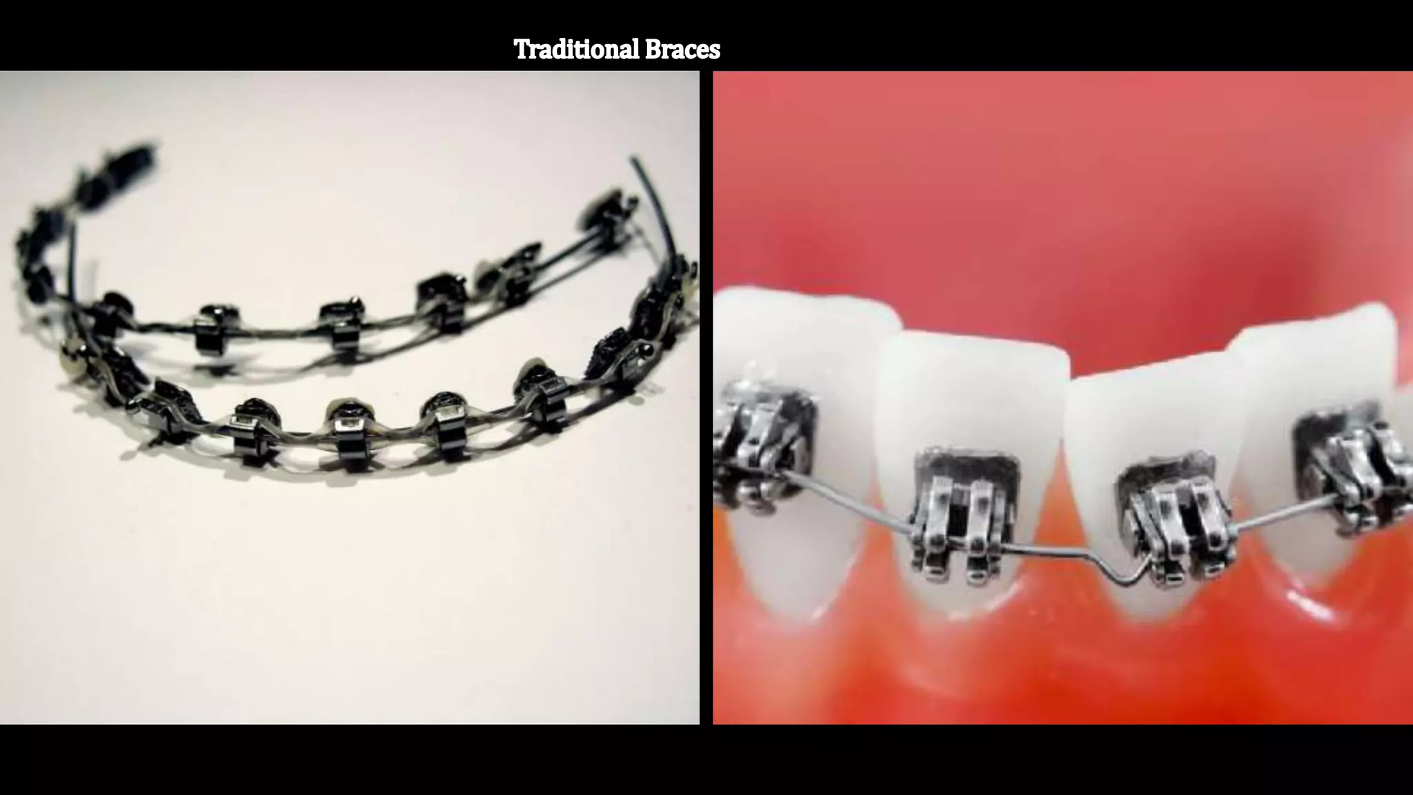 What is teeth spacing? – Its causes and cures | PPTX