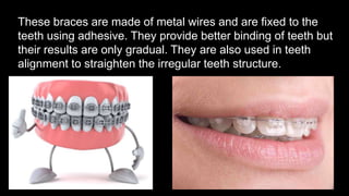 What is teeth spacing? – Its causes and cures | PPTX