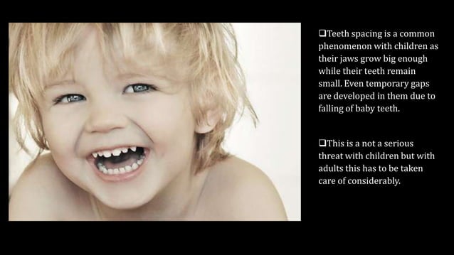 What is teeth spacing? – Its causes and cures | PPTX