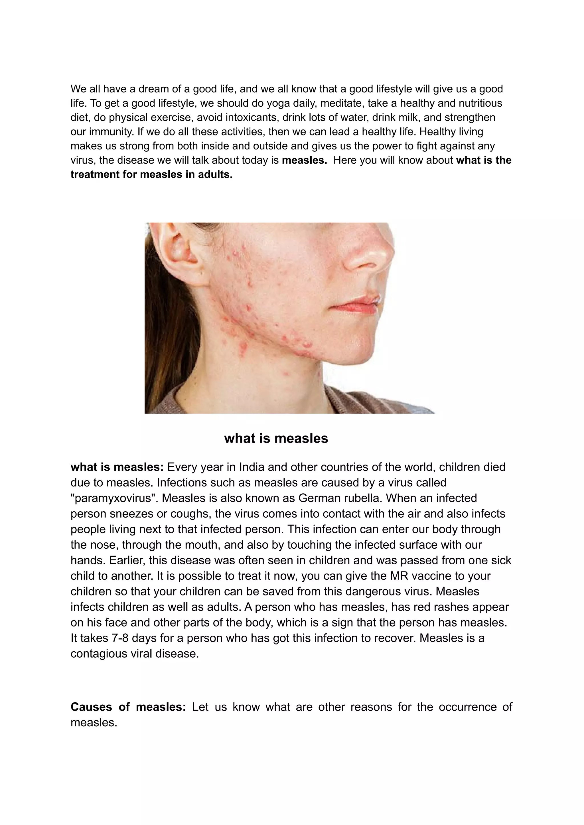 What is the treatment for measles in adults_.pdf
