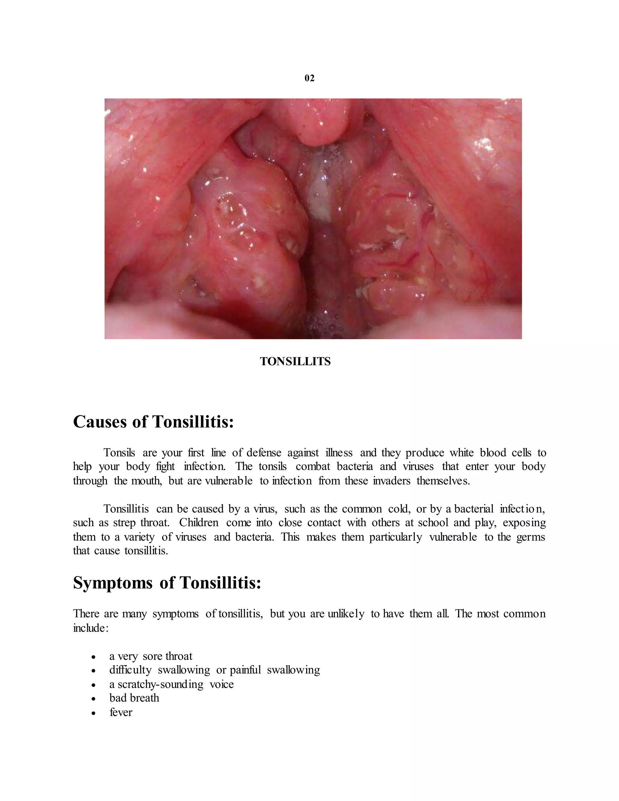 What is tonsillitis | DOCX