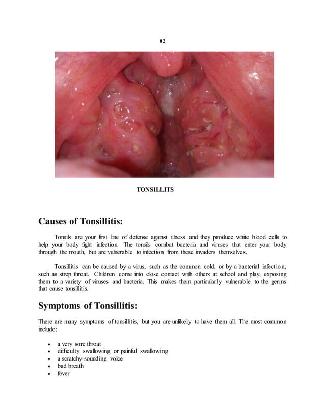 What is tonsillitis | DOCX