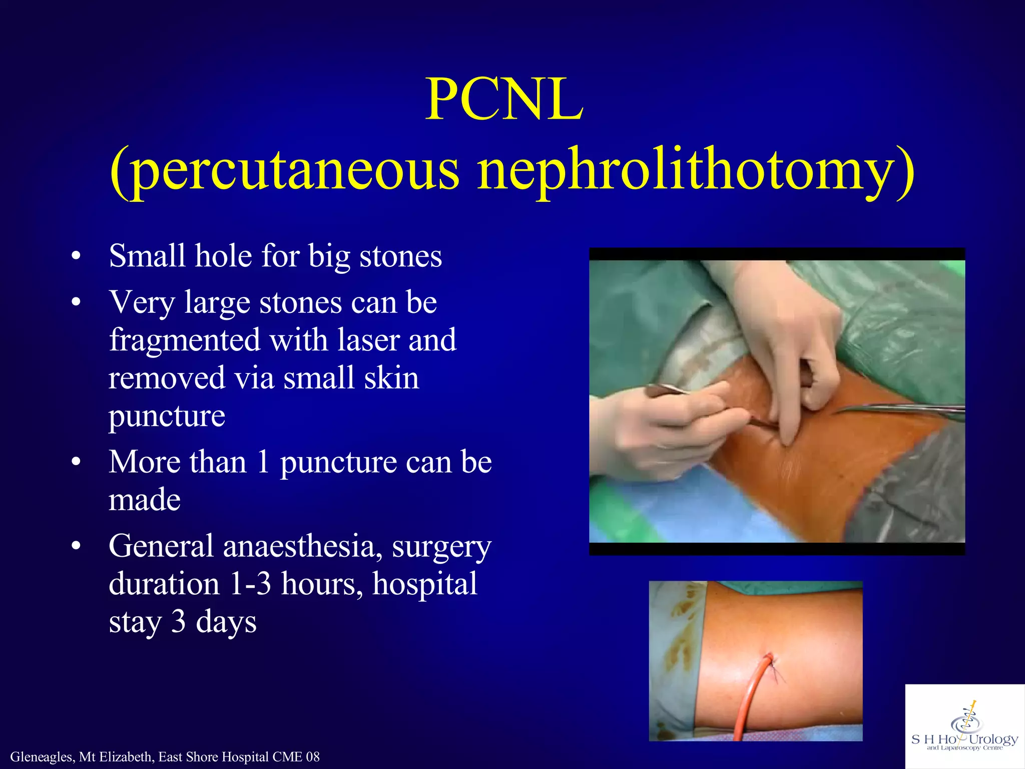 What is New In Minimally Invasive Surgery for Urology | PPT