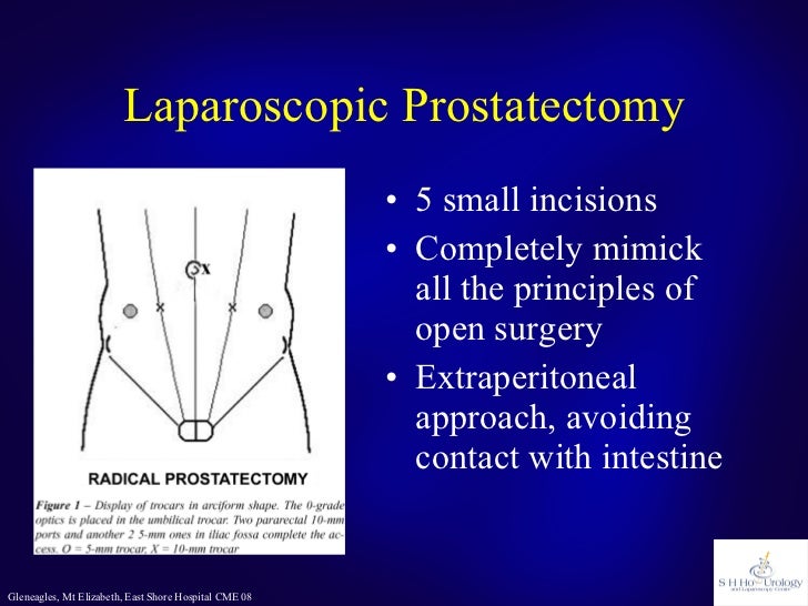 What is New In Minimally Invasive Surgery for Urology