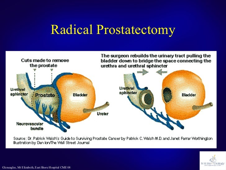 What is New In Minimally Invasive Surgery for Urology