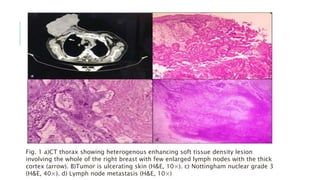 WHAT’S NEW IN BREAST PATHOLOGY 2022.pptx | Cancer | Diseases and Conditions