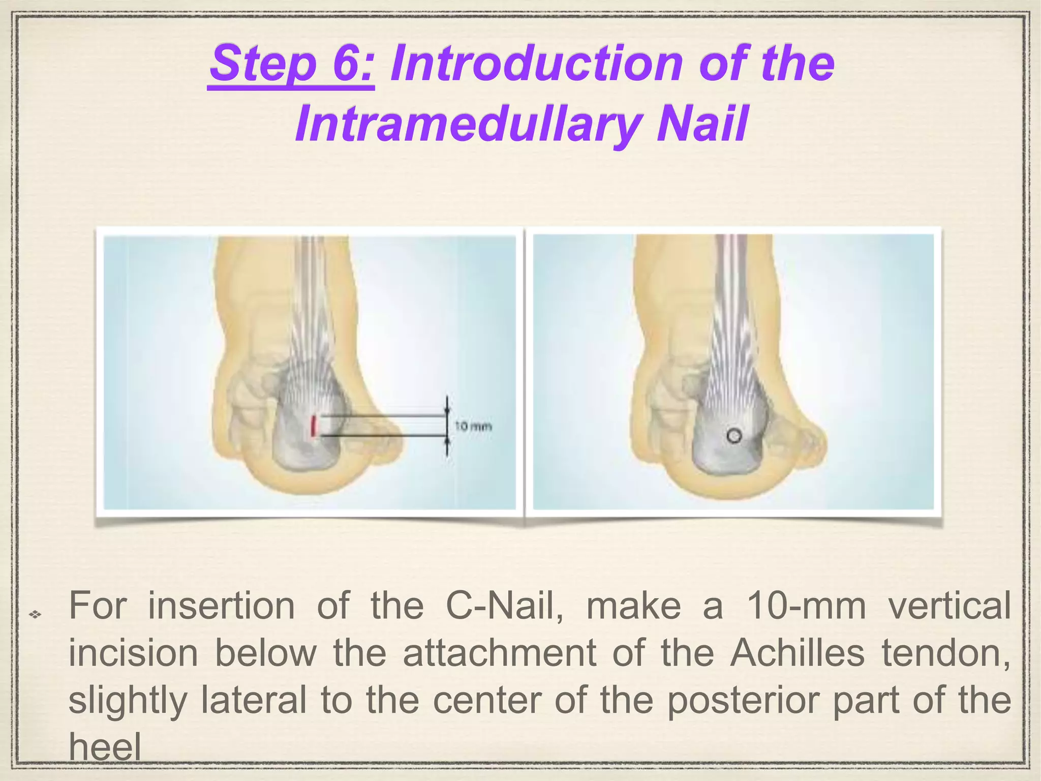 What’s New in Orthopaedic Trauma? | PPTX