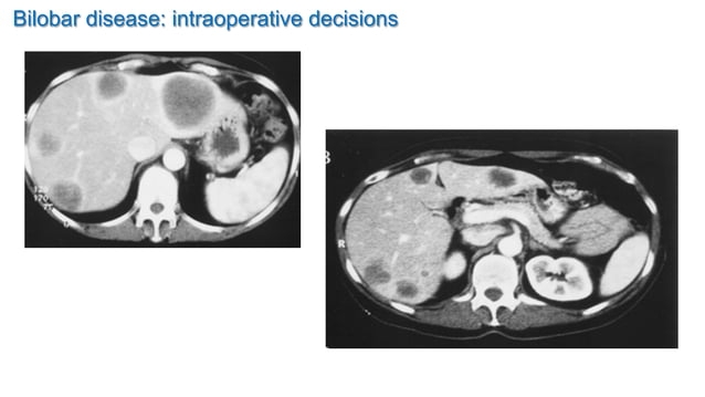 Laparoscopic Liver Resection : What to do and not do - Pr Daniel CHERQUI