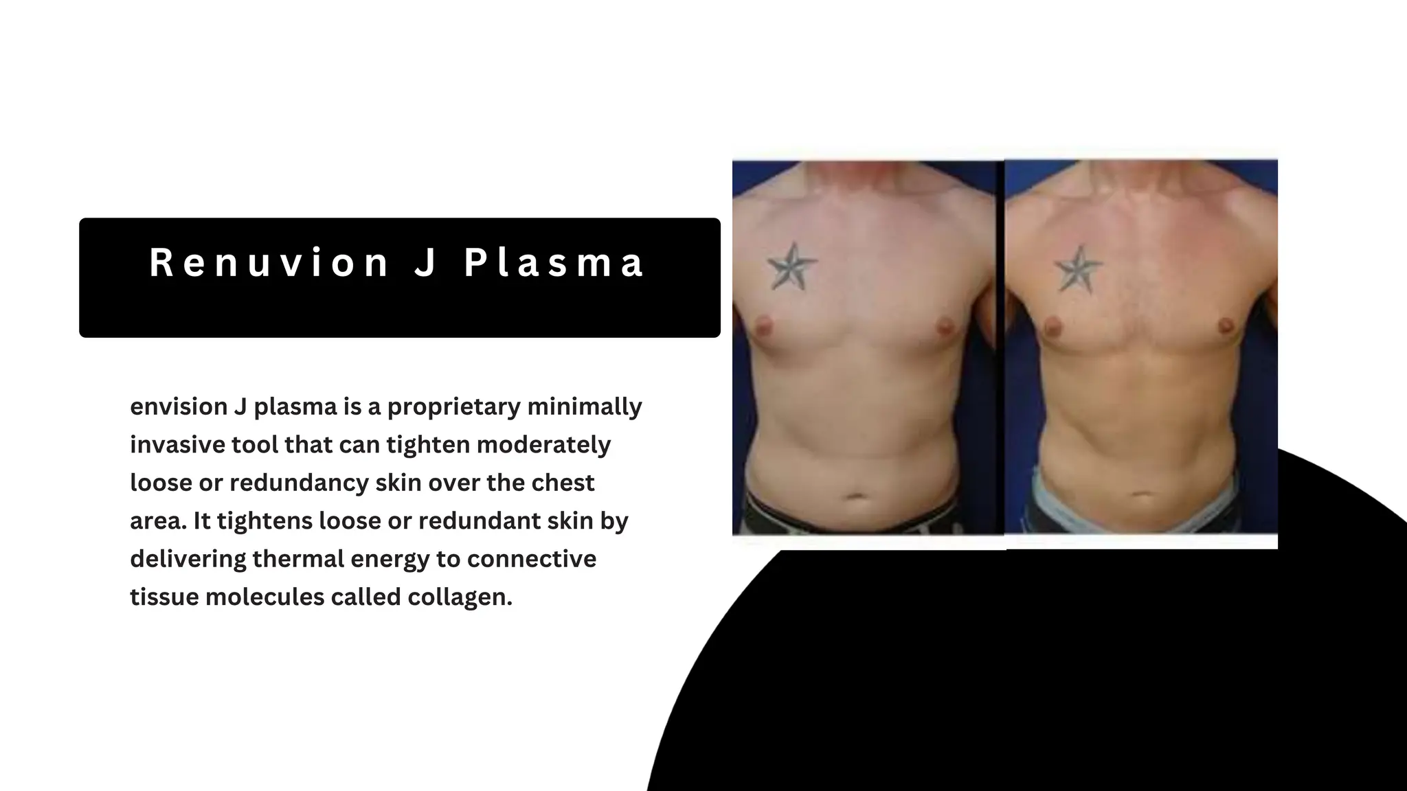 What to Expect After Gynecomastia Surgery | PPTX