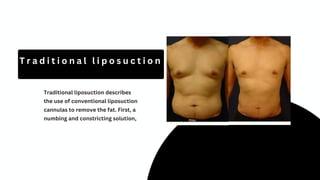What to Expect After Gynecomastia Surgery | PPTX