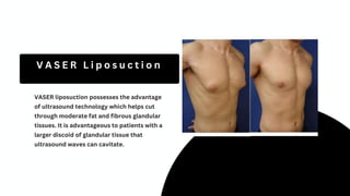 What to Expect After Gynecomastia Surgery | PPTX