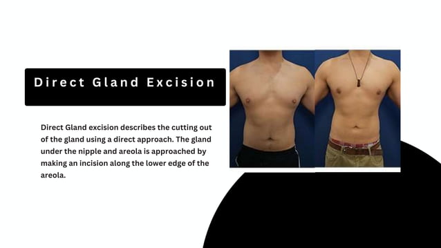 What to Expect After Gynecomastia Surgery | PPT
