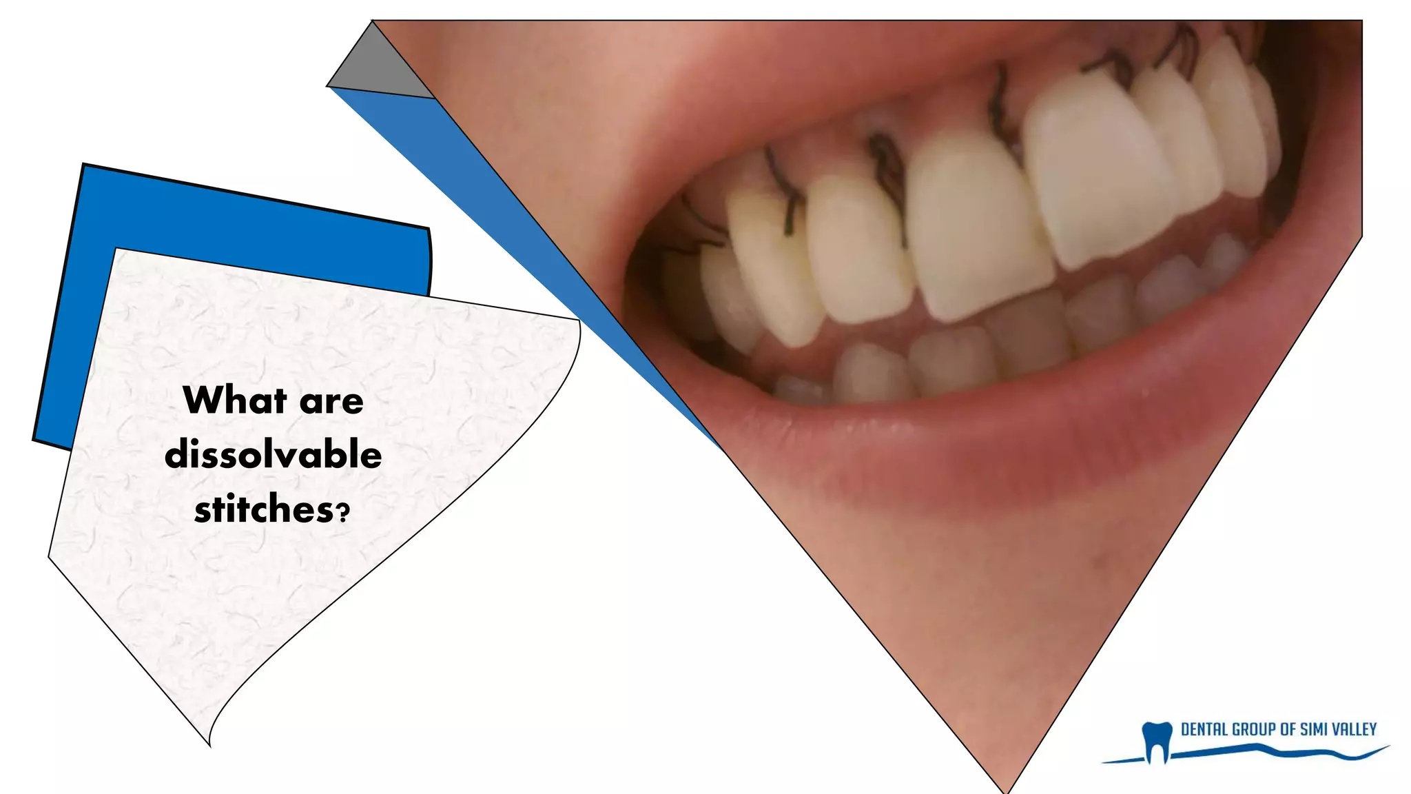 What to Know About Dissolvable Stitches After Wisdom Teeth Removal | PPTX
