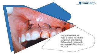 What to Know About Dissolvable Stitches After Wisdom Teeth Removal | PPT