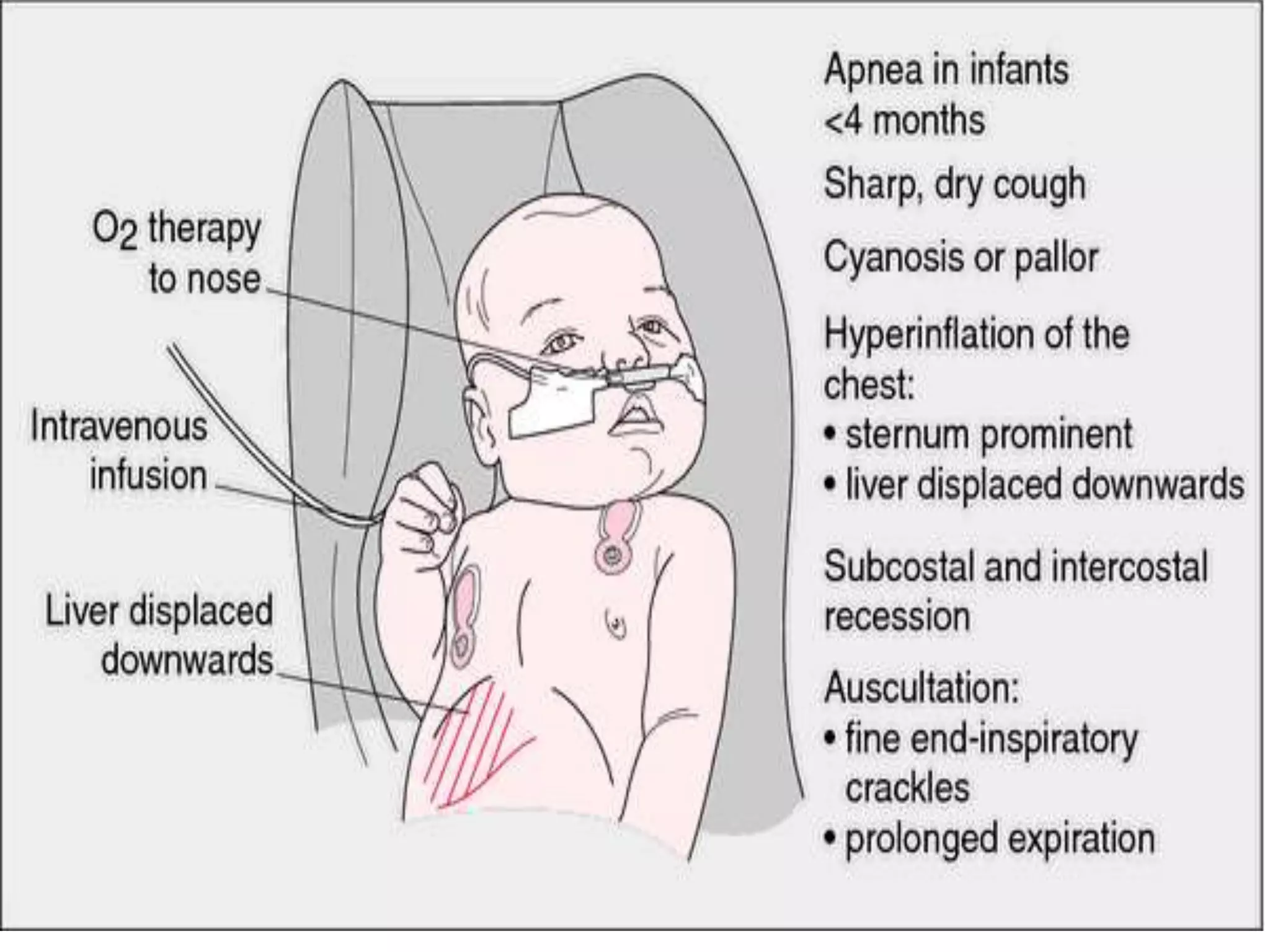 Wheezing and noisy breathing seminar | PPTX