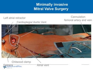 When is less more minimally invasive surgery in low ef | PPT