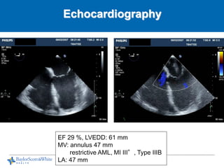 When is less more minimally invasive surgery in low ef | PPT