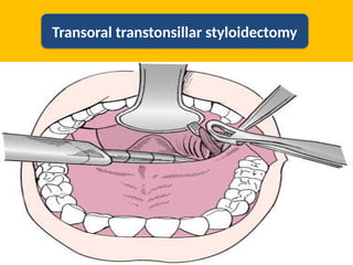 when to do tonsillectomy in children and adluts.pptx