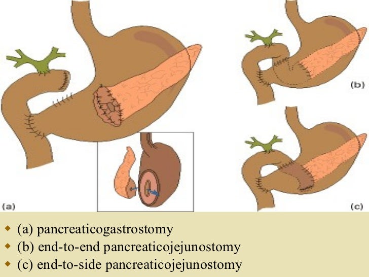 Whipple complication