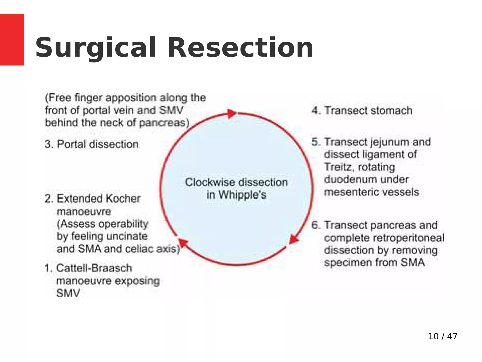 Whipple's procedure - Indications, Steps, Complications | PDF