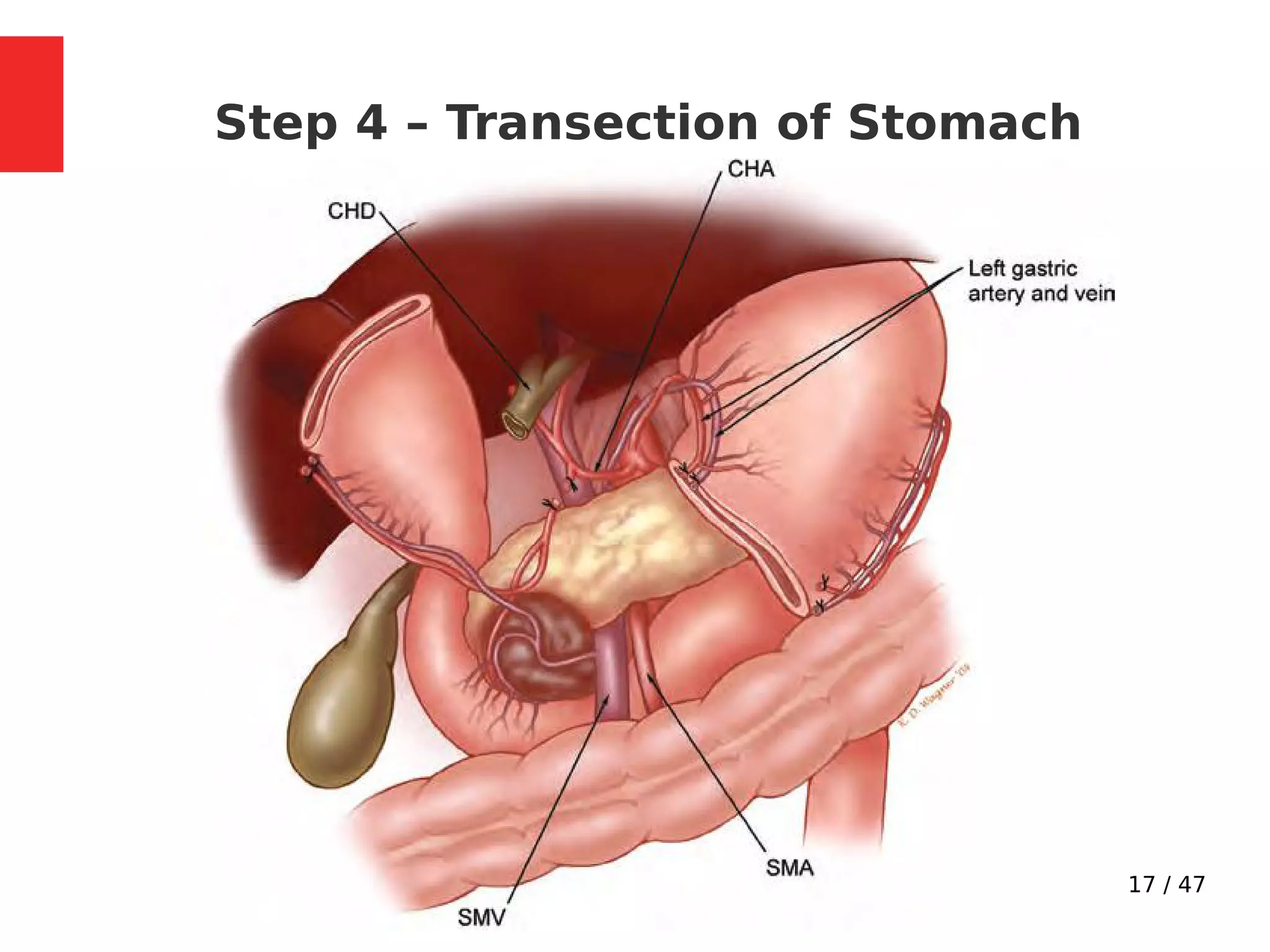 Whipple's procedure - Indications, Steps, Complications | PDF