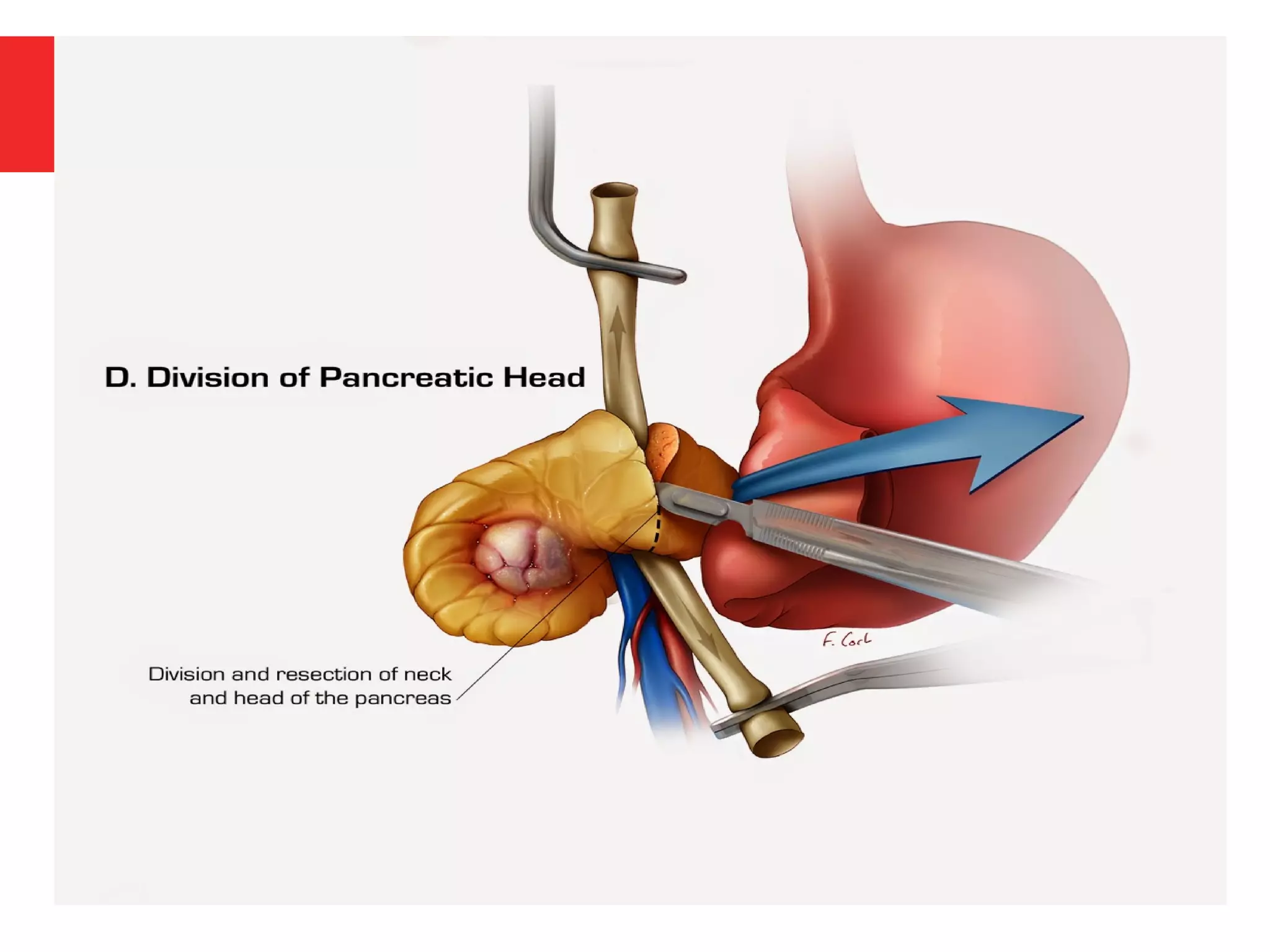 Whipple's procedure - Indications, Steps, Complications | PDF