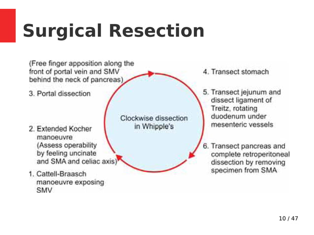 Whipple's procedure - Indications, Steps, Complications | PDF ...