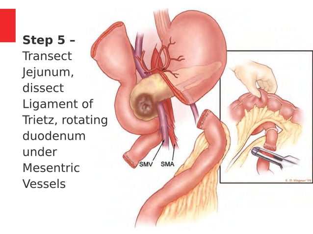 Whipple's procedure - Indications, Steps, Complications | PDF | Digestive Disorders | Diseases ...