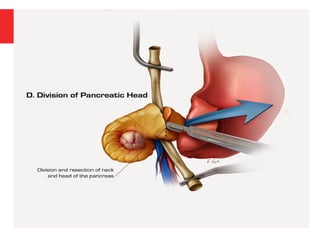 Whipple's procedure - Indications, Steps, Complications | PDF