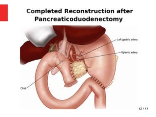 Whipple's procedure - Indications, Steps, Complications | PDF