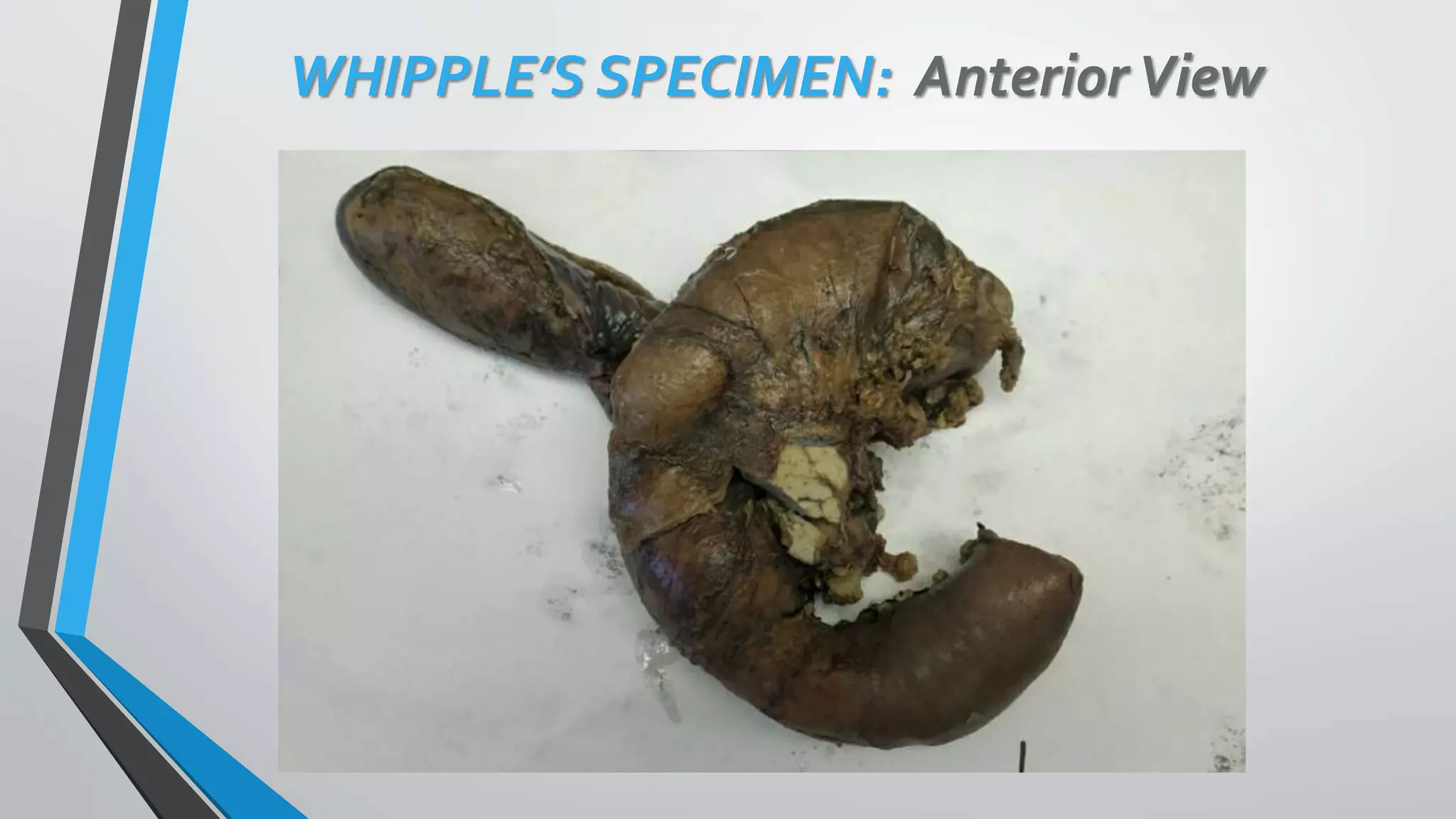 Whipple's specimen grossing | PPTX