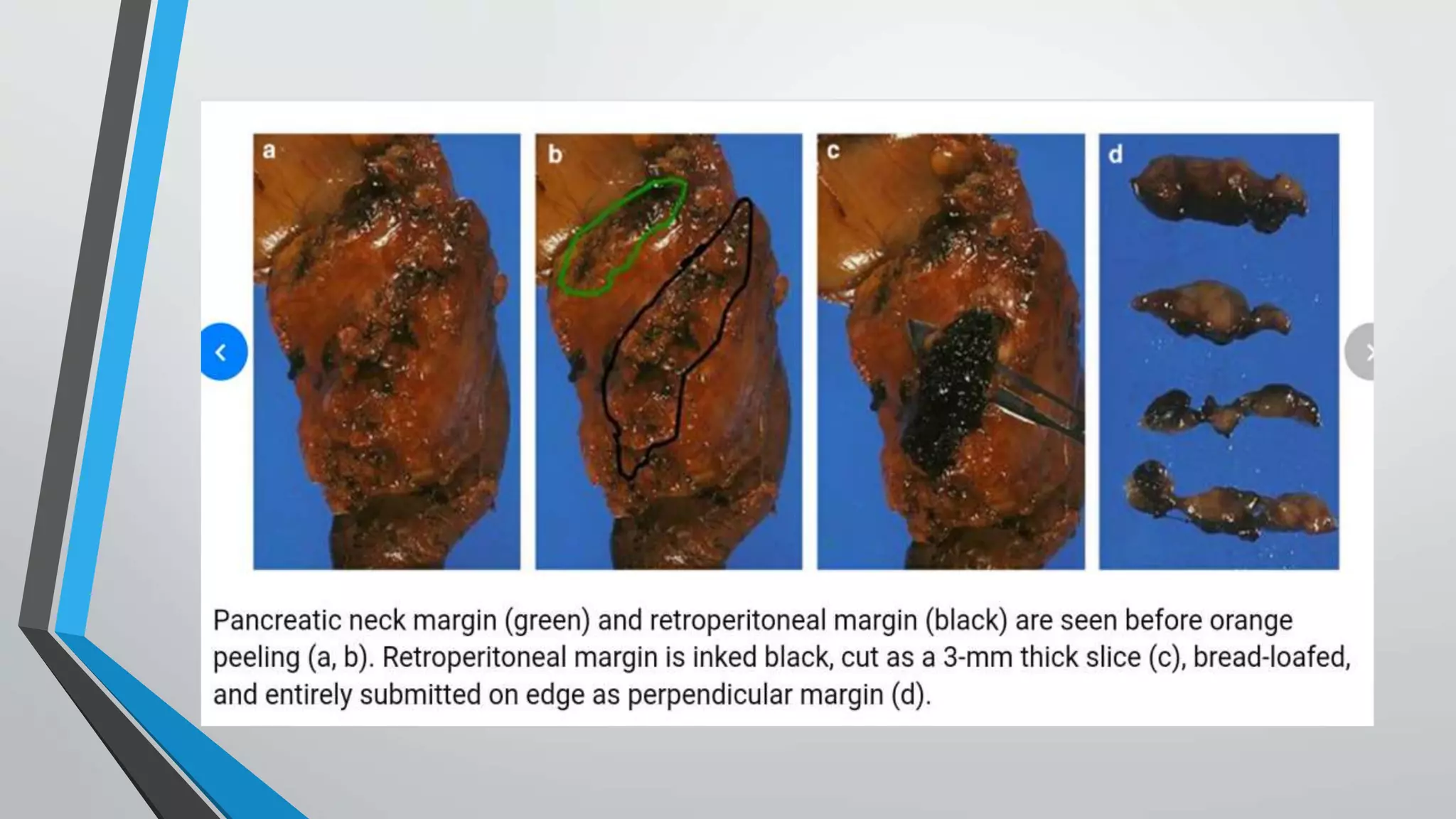 Whipple's specimen grossing | PPTX