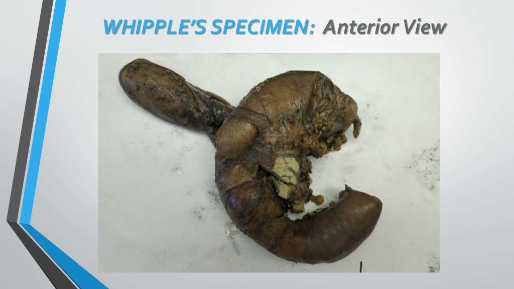 Whipple's specimen grossing