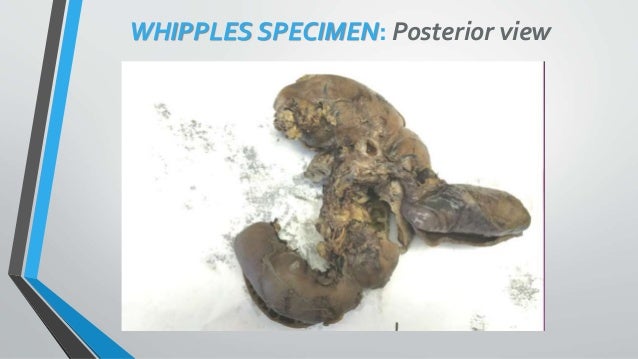 Whipple's specimen grossing