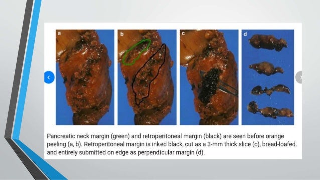 Whipple's specimen grossing