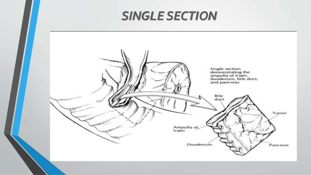 Whipple's specimen grossing