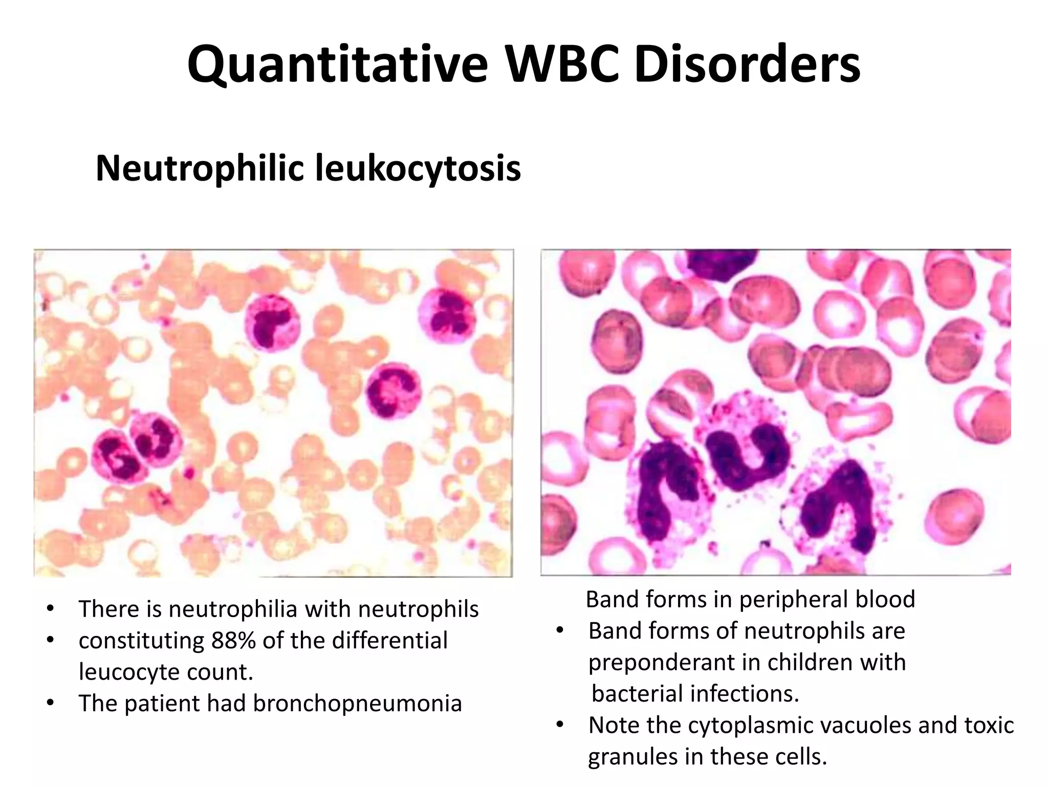 Benign White blood cell (WBC) Disorders | PPTX