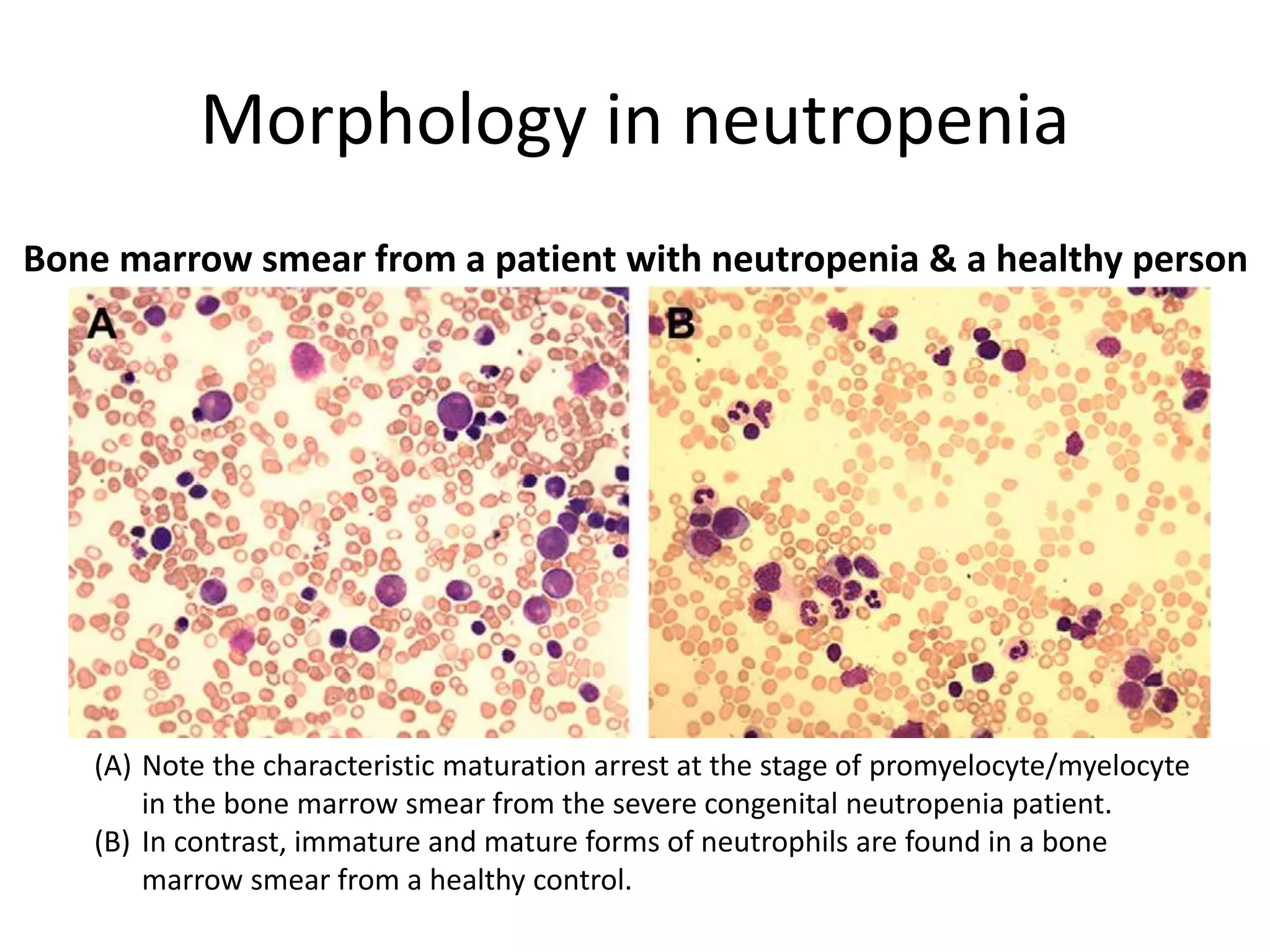 Benign White blood cell (WBC) Disorders | PPTX