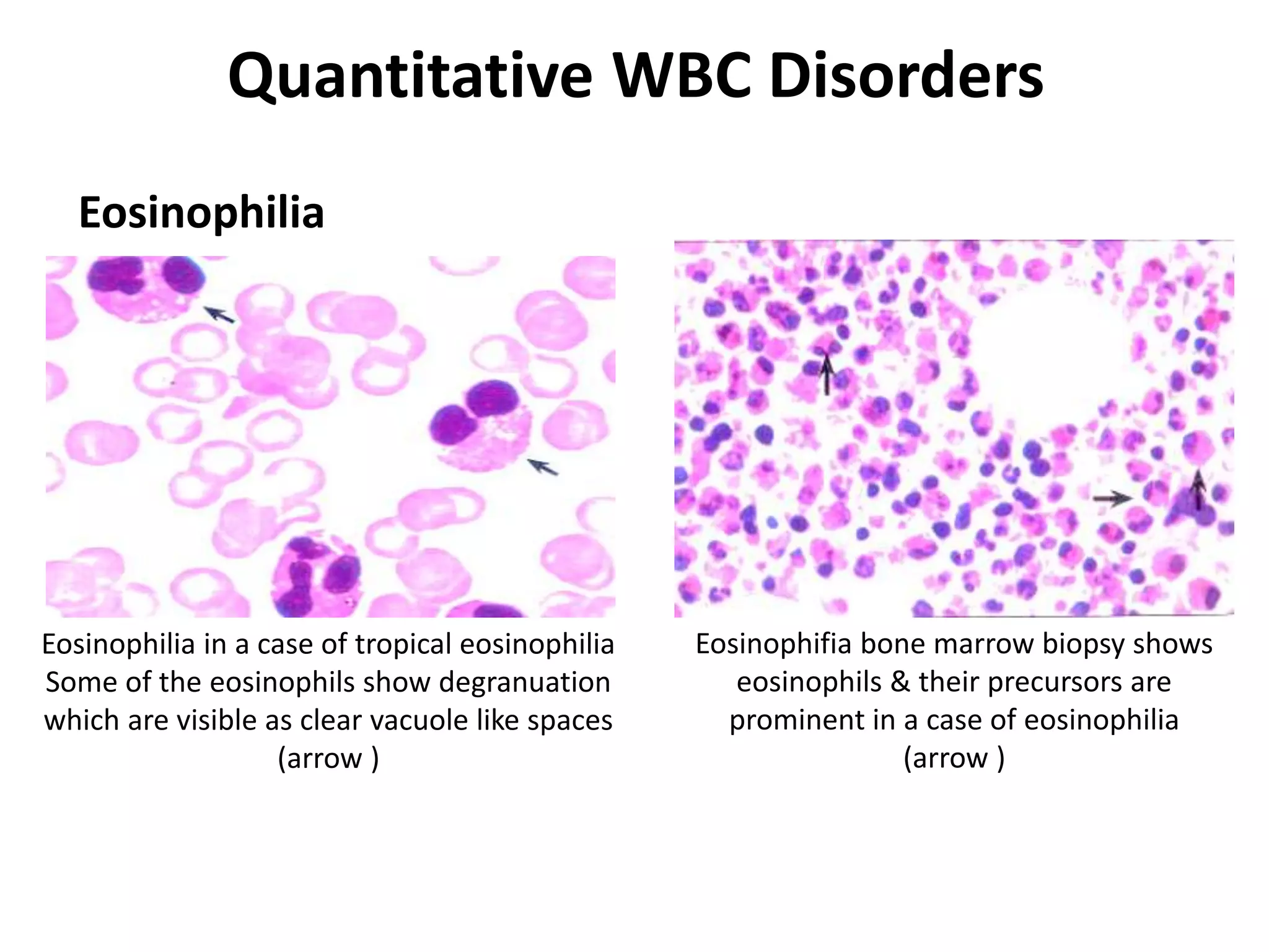 Benign White blood cell (WBC) Disorders | PPTX