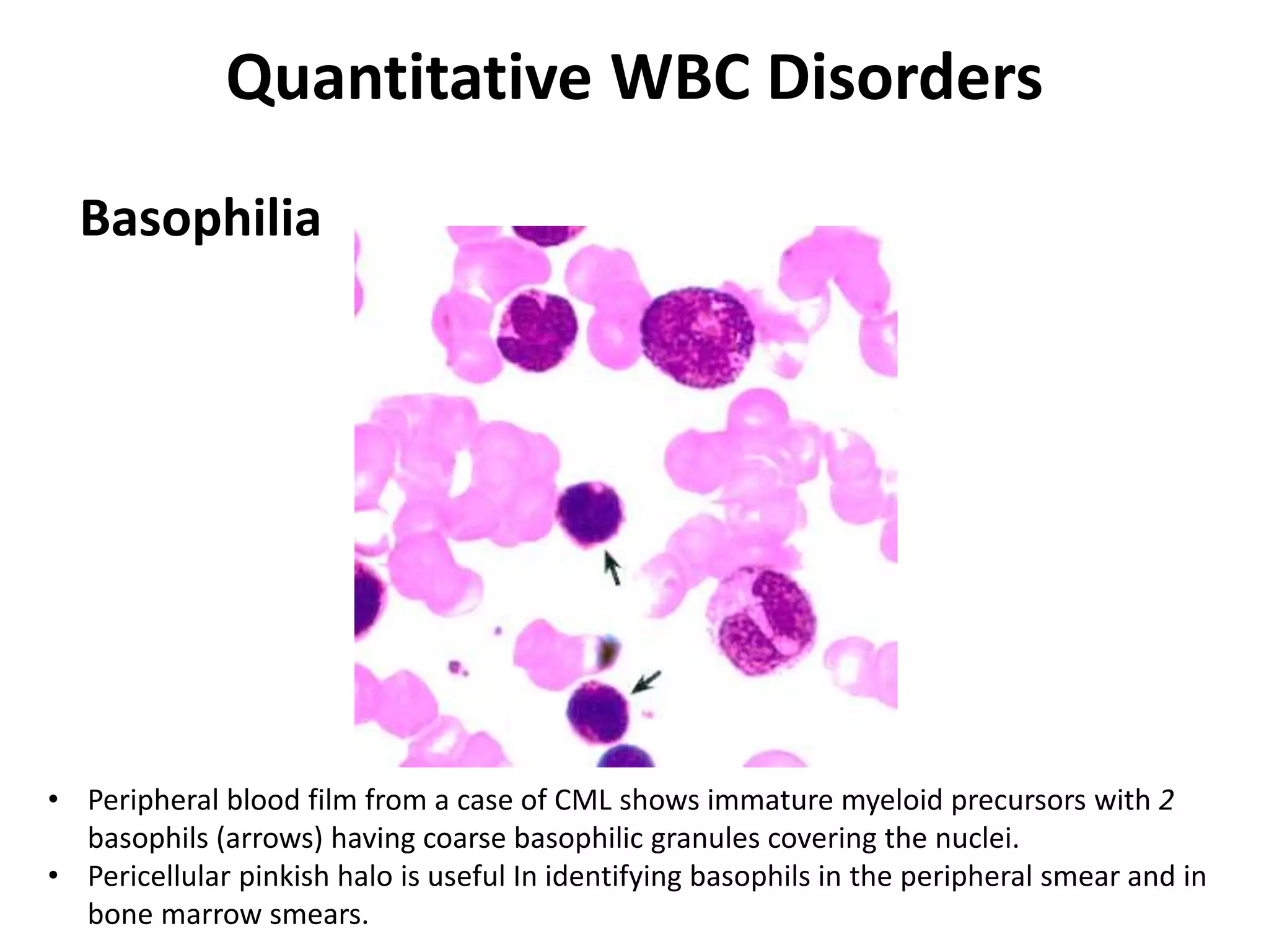 Benign White blood cell (WBC) Disorders | PPTX