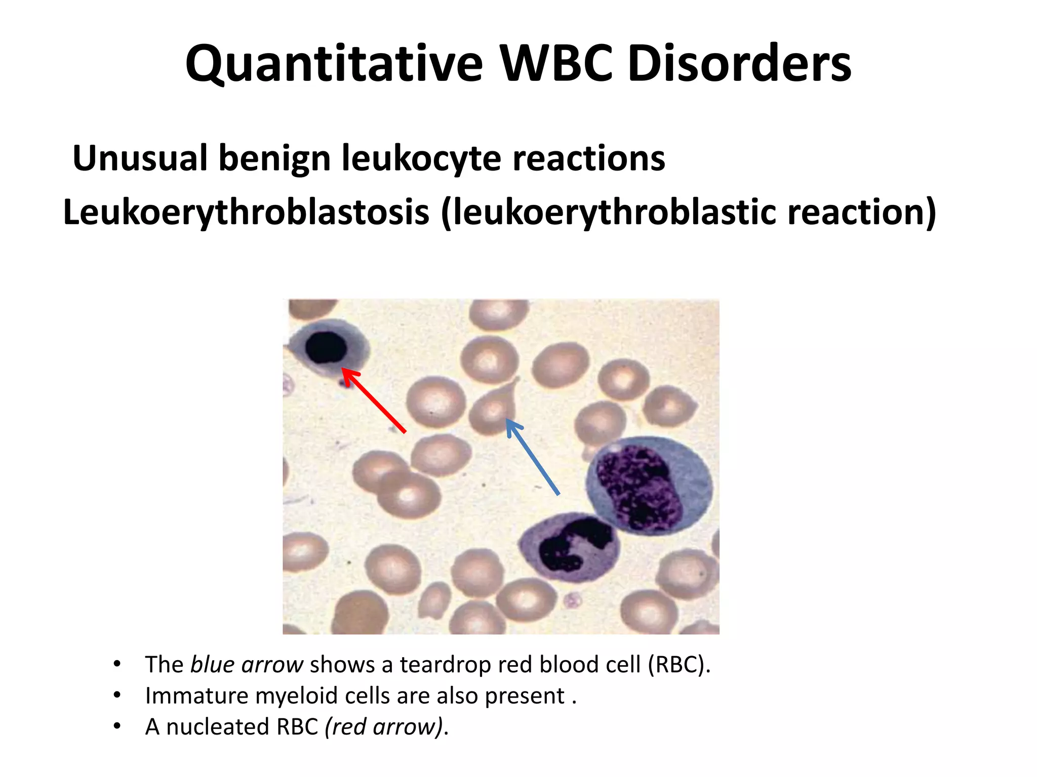 Benign White blood cell (WBC) Disorders | PPTX