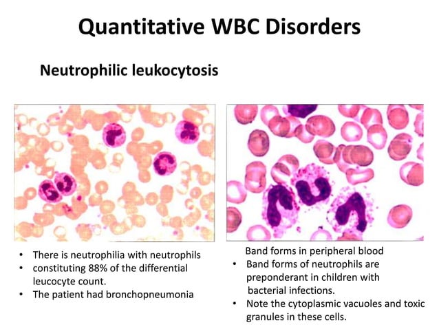 Benign White blood cell (WBC) Disorders | PPTX