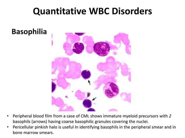 Benign White blood cell (WBC) Disorders | PPTX